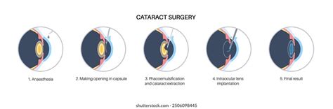 Cataract Surgery Process Anesthesia Incision Cataract Stock Vector
