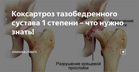 Коксартроз тазобедренного сустава 1 степени что нужно знать