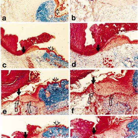Immunohistochemical Staining For Fibrin In Wounds From Plg ϩ ϩ And
