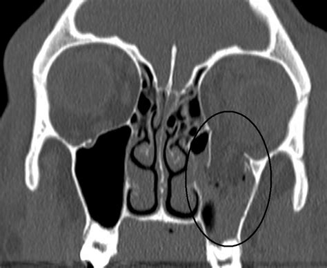 Orbital Blowout Fracture Symptoms Treatment Surgery And Recovery