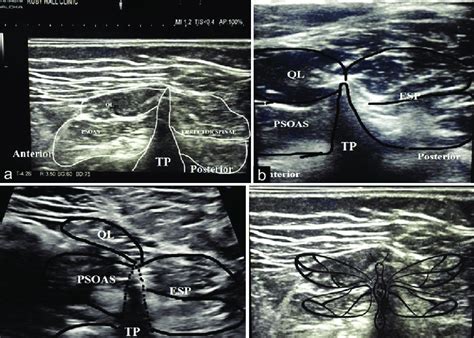 Ultrasound Scans Of Lumbar Paravertebral Sonoanatomy In A 1 8years