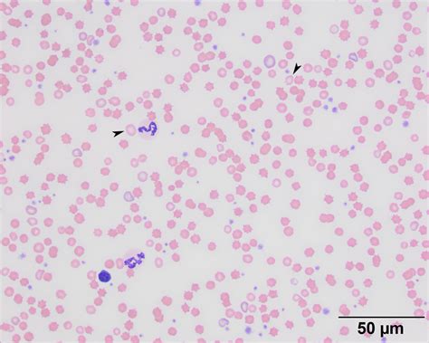 Polychromasia Archives Eclinpath