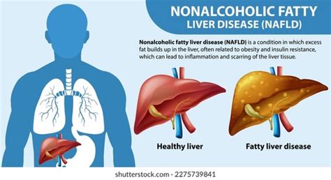 Nonalcoholic Fatty Liver Disease Nafld Illustration Stock Vector