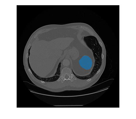 Segmentobjectsfromembeddings Segment Objects In Medical Image Using
