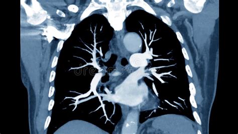 Ctpa Or Cta Pulmonary Artery For Diagnostic Pulmonary Embolism And X28pe