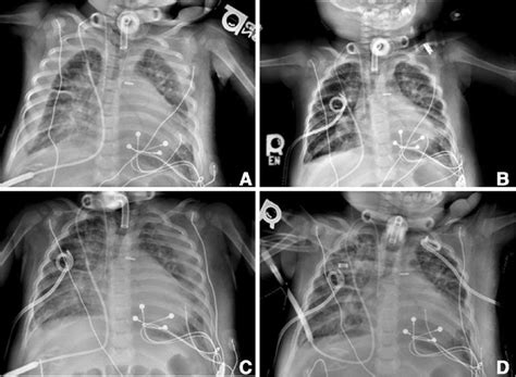 Pleural Effusion Chest X Ray Description At John Whyte Blog