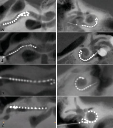 Four Fold Overs Were Observed Depicted On The Left With Uncoiled Download Scientific Diagram
