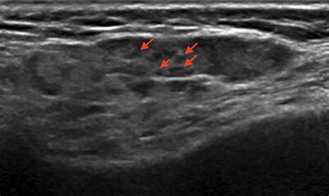Salivary Gland Ultrasound In Primary Sjögrens Syndrome Oarrr