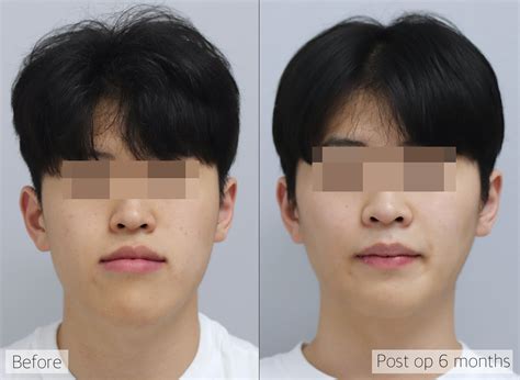 양악수술 사각턱 앞턱