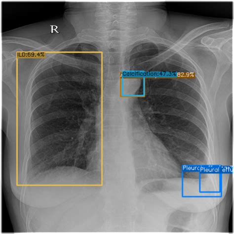 GitHub Bbonghag Chest X Ray Object Detection DL Object Detection Project