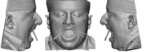image showing the importance of soft tissue reconstruction in