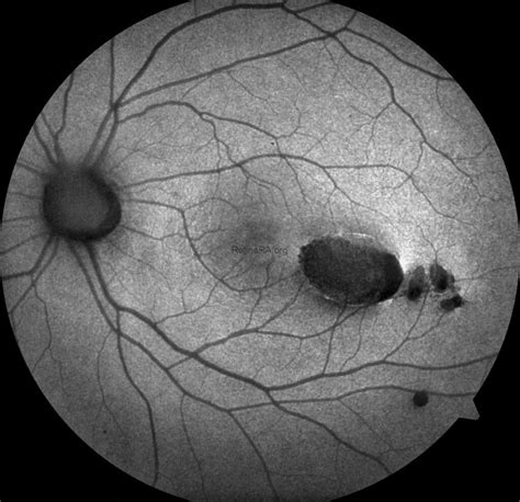 Torpedo Maculopathy Retinara
