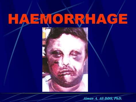 Bleeding Disorder1 Ppt