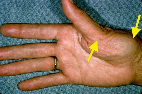 Osteoarthritis Carpometacarpal Cmc Joint Of Thumb Hand Surgery Resource
