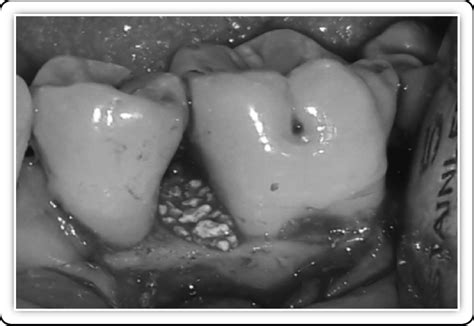 Defect Was Filled With Beta Tricalcium Phosphate Up To The Vertical Download Scientific Diagram