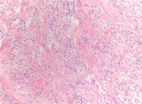Histiocytoid Pyoderma Gangrenosum A Challenging Case With Features Of