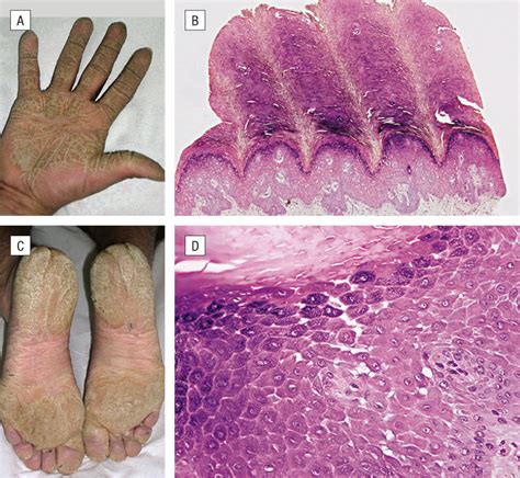 Diffuse Nonepidermolytic Palmoplantar Keratoderma Caused By A Recurrent