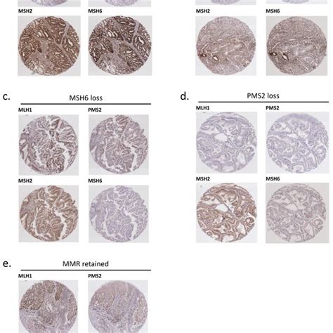 Expression Of Mismatch Repair Mmr Proteins In Endometrioid Download Scientific Diagram