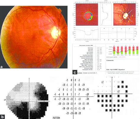 Female 55 Years With Primary Open Angle Glaucoma Showing A Right Download Scientific Diagram