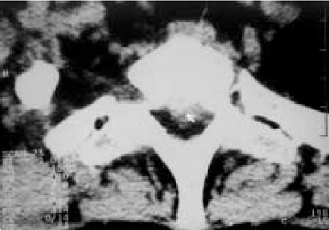 Figure 1 From Intradural Disc Herniation At The T1 T2 Level Semantic