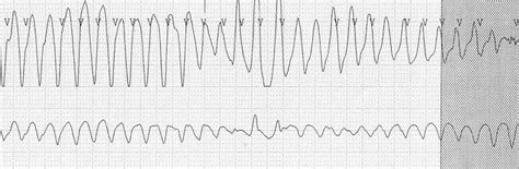 Torsades De Pointes During Short Term Amiodarone Treatment Download