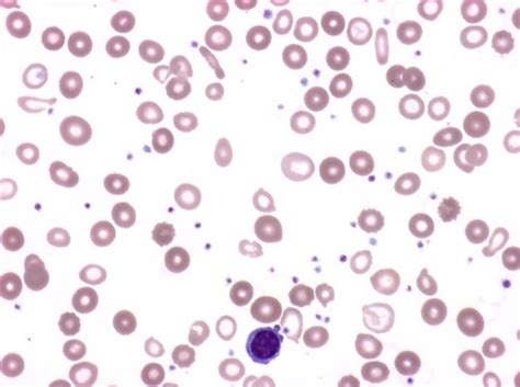 Microcytic Anemias Flashcards Quizlet