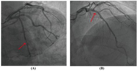 Entropy Based Reliable Non Invasive Detection Of Coronary Microvascular