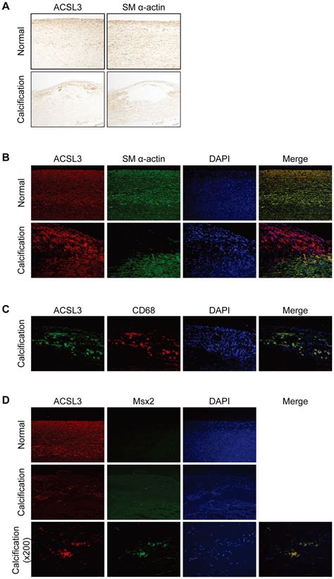 The Expression Of Acsl In Normal And Calcified Human Carotid Artery