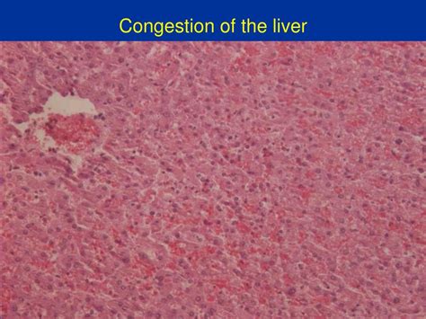 Ppt Pathology Of The Liver Powerpoint Presentation Free Download