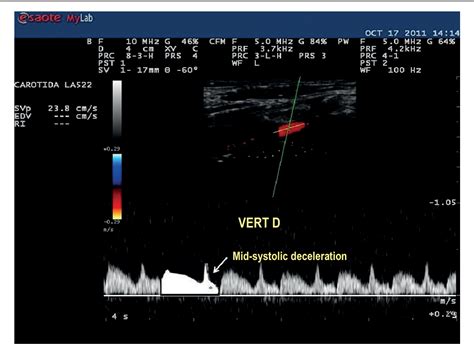 Subclavian Steal Syndrome Ultrasound
