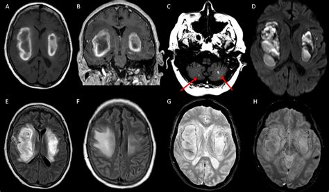A Axial T Spin Eco SE Showed Central Hypointense With Peripheral Download Scientific