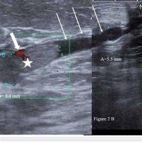 A A Homogeneous Isoechoic Solid Intraductal Nodule White Star Download Scientific Diagram