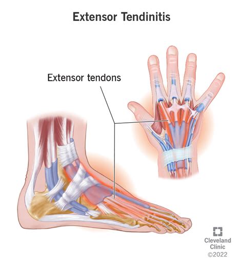 Extensor Tendonitis Tendinopathy Symptoms Causes And Treatment Hot Porn Sex Picture