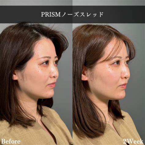 Prismノーズスレッド Prism Beauty Clinic プリズムビューティークリニック 東京町田の美容外科・美容整形・美容