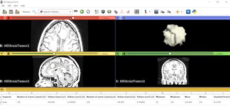 Brain Tumor Segmentation Slicer Segmentation Medical