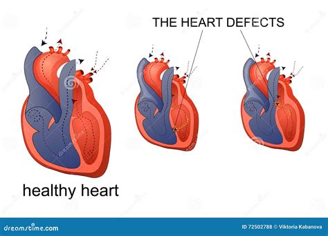 Healthy Aortic Valve Or Aortic Valve Stenosis Type Of Heart Valve