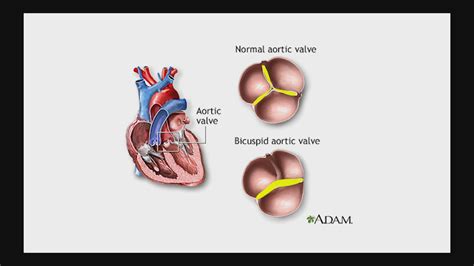 Health Spotlight Ross Procedure Only Valve Replacement With A Long