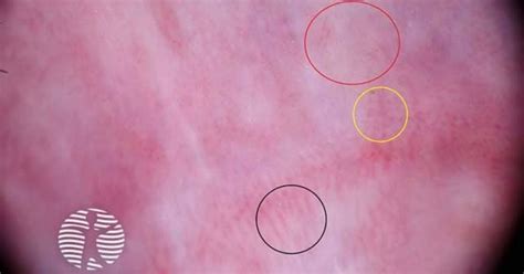 Lichen Sclerosus 00003 Image