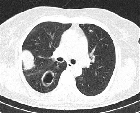 Multiple Bilateral Masses Associated With A Cyst In The Lung Download