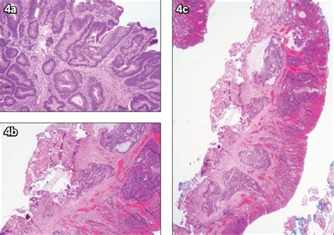 Endoscopic Submucosal Dissection Of Colorectal Neoplasms An Audit Of Its Safety And Efficacy In