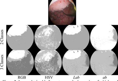 Figure 3 From Using Cystoscopy To Segment Bladder Tumors With A Multivariate Approach In