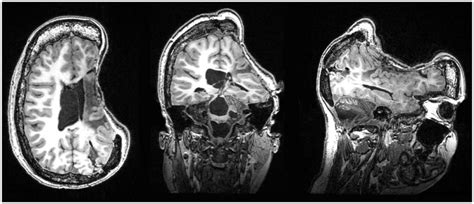 T1 Weighted Mri Image Acquired At T0 Is Shown In 3 Representative
