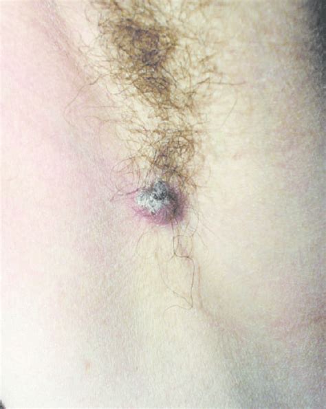 Hyperpigmented Nodule Localized On The Left Axilla Of The Patient