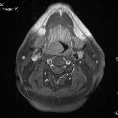 Mri Aspect Of The Tumor Which Lies Between The Palatine Tonsils And