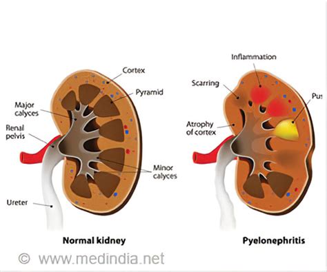 Renal And Urologic Disorders Flashcards Quizlet