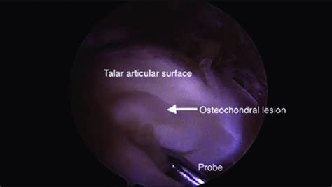 Arthroscopic Photograph Of The Osteochondral Lesion Seen At The Lateral