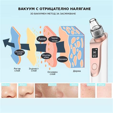 Уред с вакуум за почистване на черни точки вкъщи НЕКТЕЙН