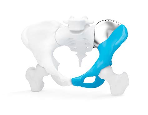 Reconstructive Implants Tecumed Sro Reconstructive Implants Tecumed Sro