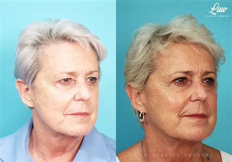 Eyelid Surgery Before After Photos Sage Plastic Surgery
