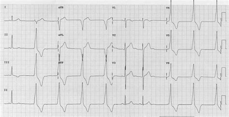Accelerated Idioventricular Rhythm Aivr • Litfl • Ecg Library